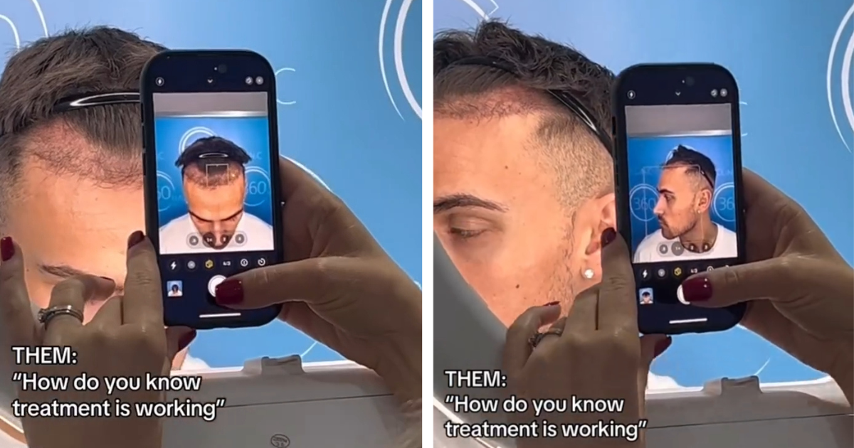How Ben from Love Island Transformed After £3000 Hair Transplant - May 2025